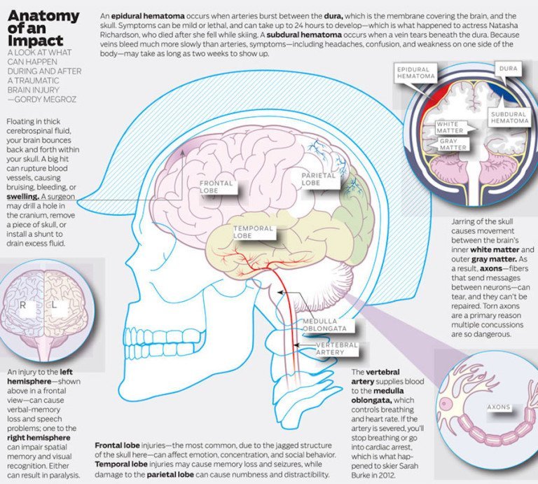NH Personal Injury Lawyers | Traumatic Brain Injuries